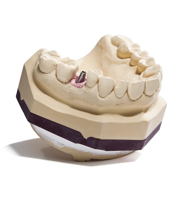 Gesso Pedra Especial Zero Stone Tipo IV Dentona