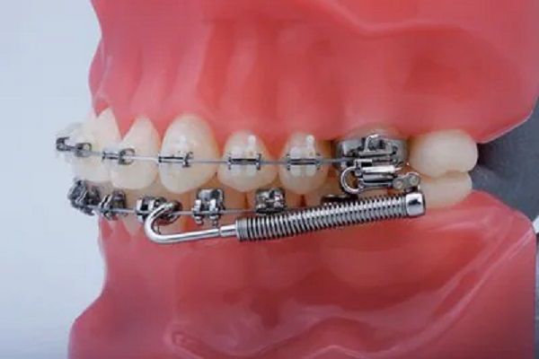 Corretor de Classe II Forsus EZ2 Module 3M Solventum